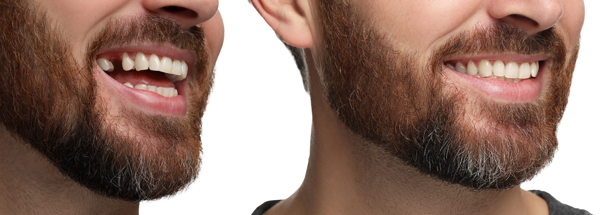 Dental Implants Before & After | Springbank Dental Centre